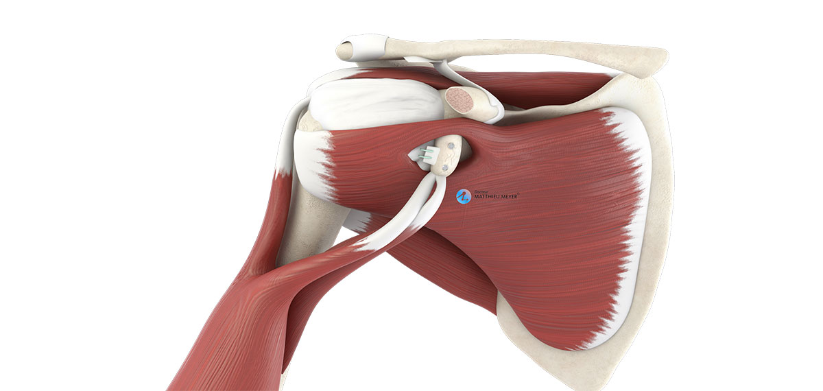 Opération Latarjet Épaule: Latarjet Procedure – DFQMO