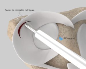 méniscectomie et suture méniscale par arthroscopie - Docteur Matthieu Meyer