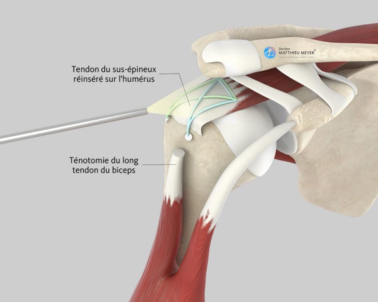 Réparation de la coiffe des rotateurs par arthroscopie - Docteur ...