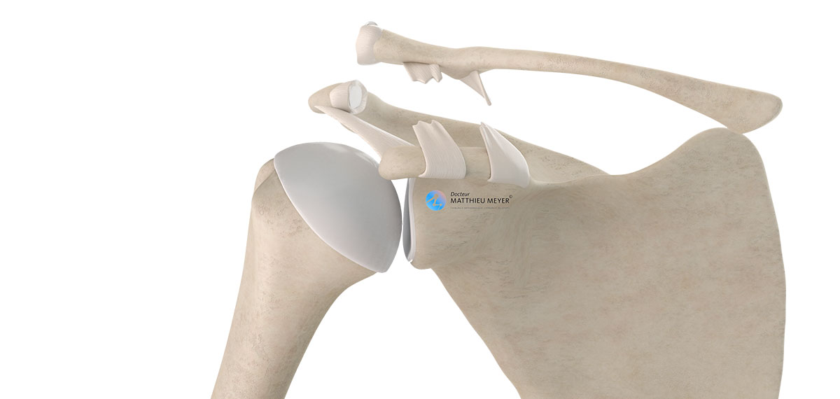 Luxation acromio-claviculaire - Docteur Matthieu Meyer