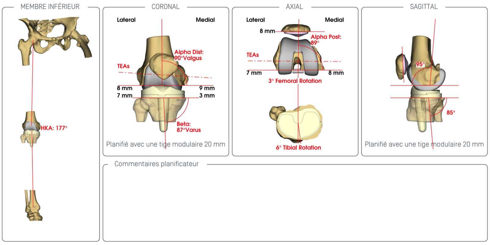 Prothèse totale de genou sur mesure avec planification 3D par scanner ...