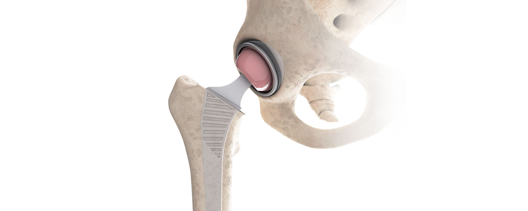 Coxarthrose : Quand opérer ? - Docteur Matthieu Meyer